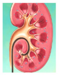 Urétéro-rénoscopie souple et laser - Urogard